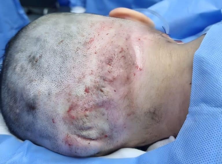 Medcare saves girl from one of world's largest scalp tumors